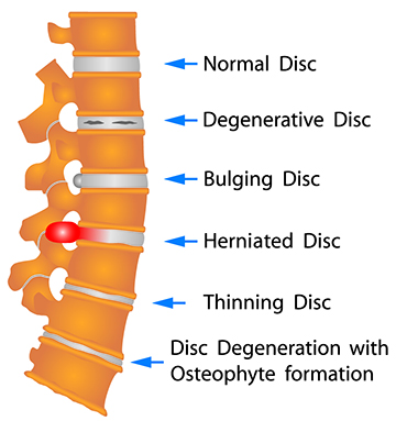 Disc Injury Treatment in Inverness - Moss Chiropractic of Inverness